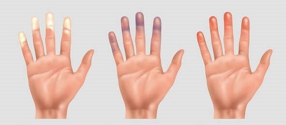Fenômeno de Raynaud: sintomas, causas e tratamento