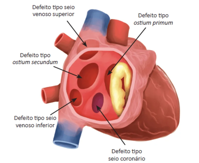 Modelo De Coracao Septo Interatrial Comunicação Interatrial (CIA):
