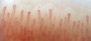 Capilaroscopia: o que é, para que serve e como é feita?